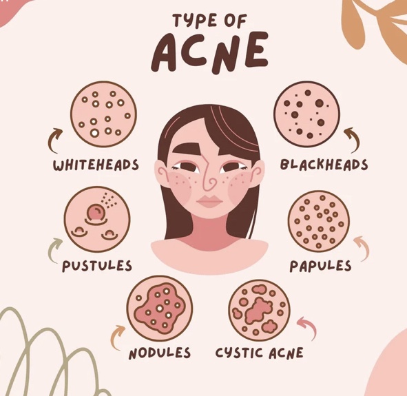 Acne Awareness Month – Skin Deep Beauty by Christine Lindsay